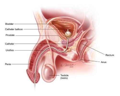 suprapubic catheter problems
