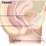 intermittent catheterization procedure