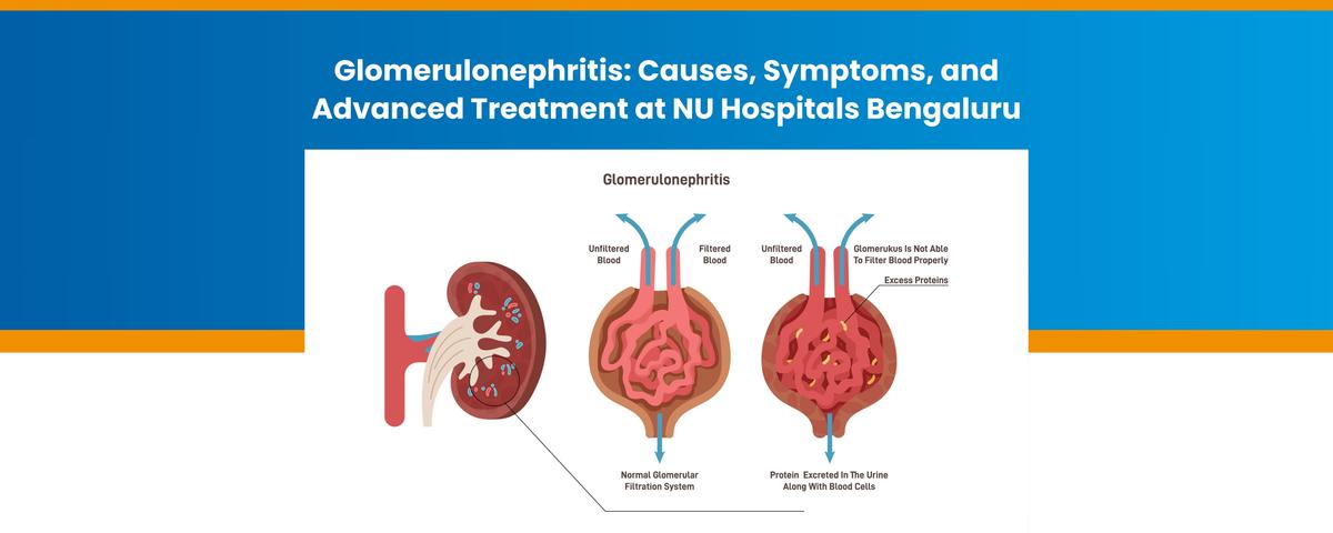 glomerulonephritis causes