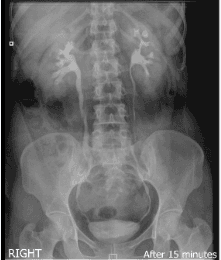 Intravenous Urography (IVU) Test in Bangalore | NU Hospitals