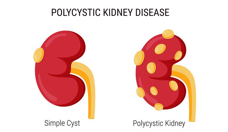 Kidney Cysts: Size and Risks Explained| Causes & Treatment | NU ...