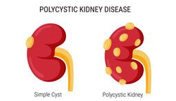 Kidney Cysts: Size and Risks Explained| Causes & Treatment | NU ...