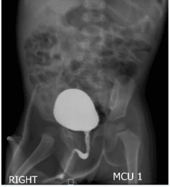 MCU Test (Micturating Cystourethrogram): Procedure, Purpose, and ...