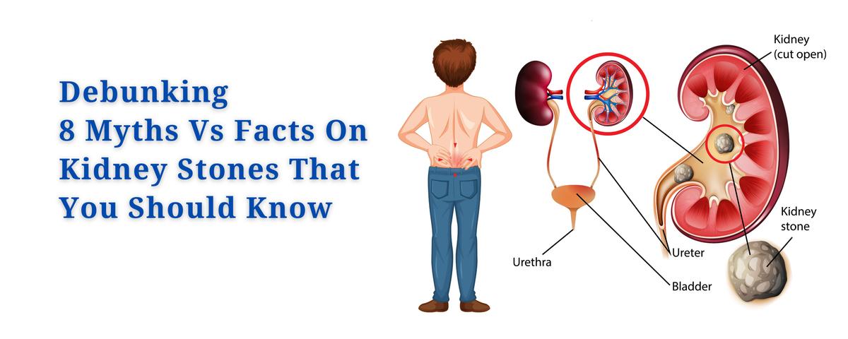 Debunking 8 Myths Vs Facts On Kidney Stones | NU Hospitals