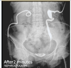 HoLEP vs TURP: Comparing Prostate Enlargement Treatments for Better ...