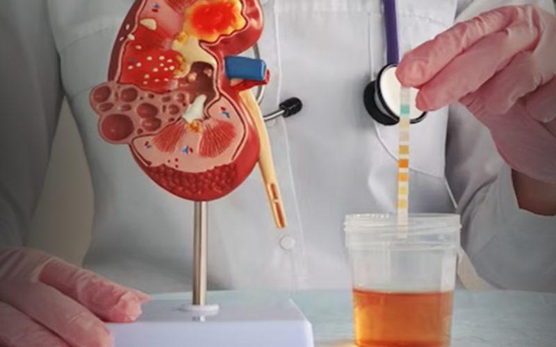 Nephrotic Syndrome Diet and its Complications | NU Hospitals