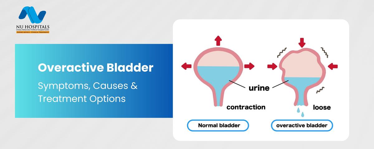 Overactive Bladder (OAB) Symptoms, Causes & Treatment | NU Hospitals