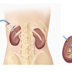 nephrostomy side effects