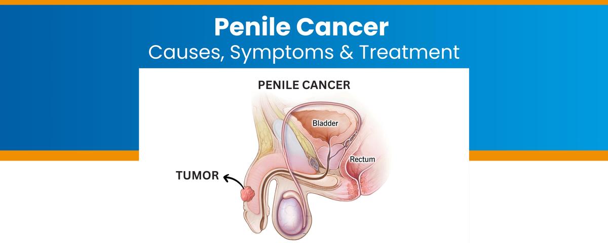 what are the effects of penile cancer