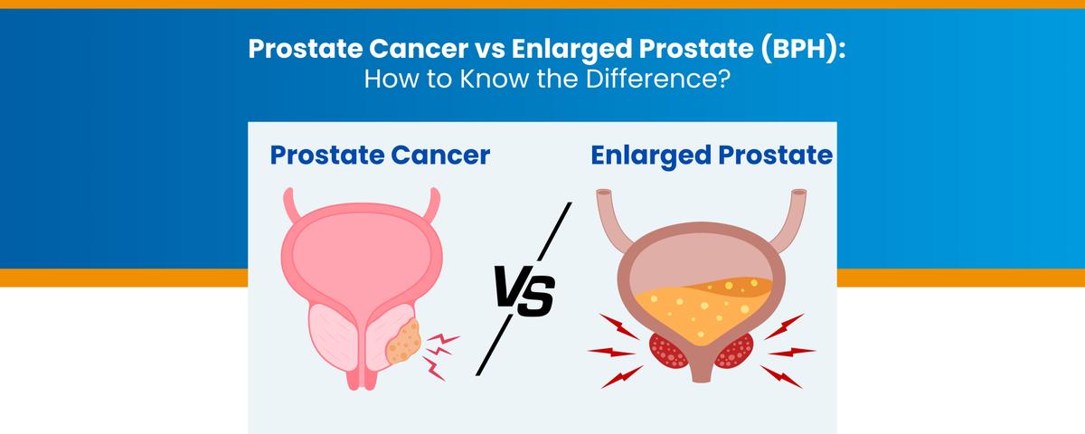 prostate gland cancer causes